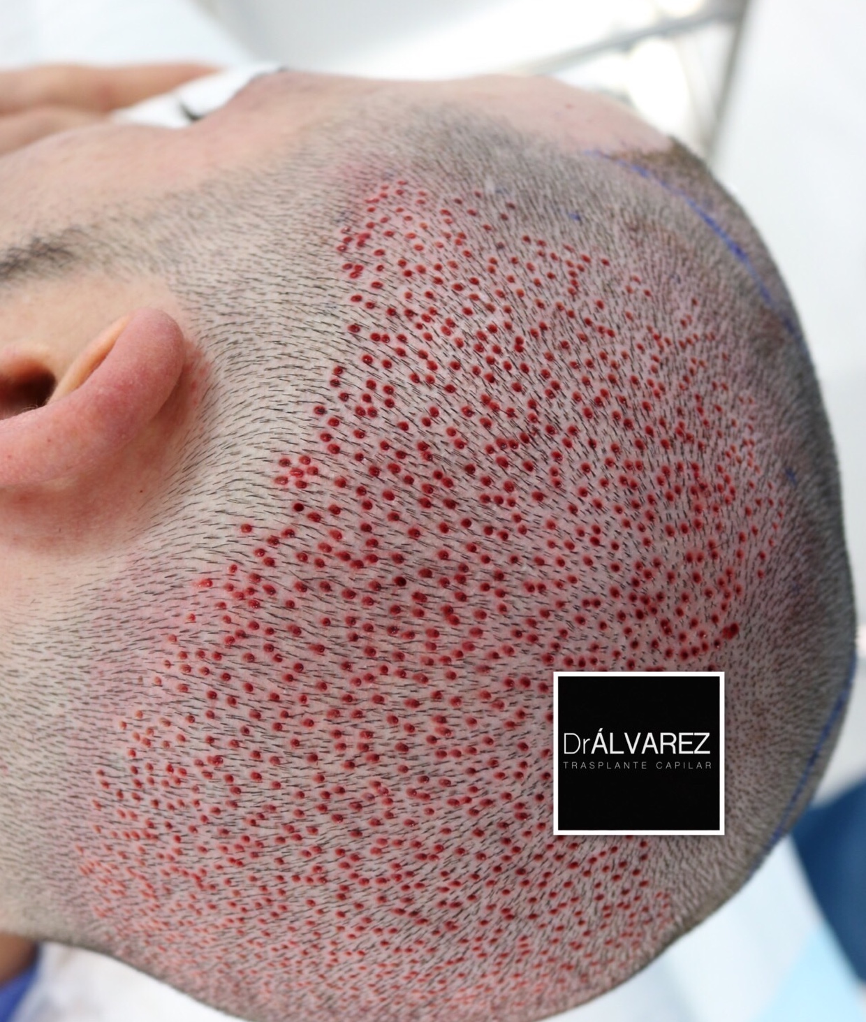 Injerto Capilar | Clínica Trasplante Capilar Dr. Xavier Álvarez